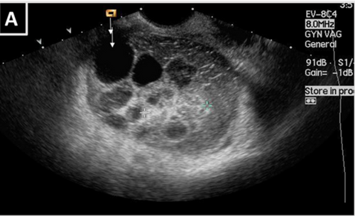 Brenner Tumor Ultrasound