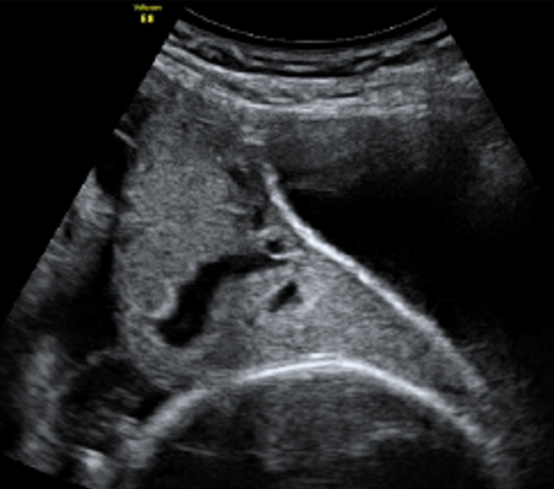 Abnormally invasive placenta and vasa previa