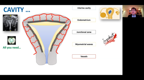 The one stop fertility scan: assessing the endometrial cavity ...