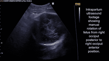 UOG videoclip: Real-time ultrasound demonstration of successful manual ...
