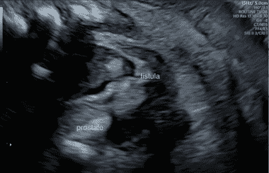 UOG videoclip: Value of fetal pelvic ultrasound examination in ...