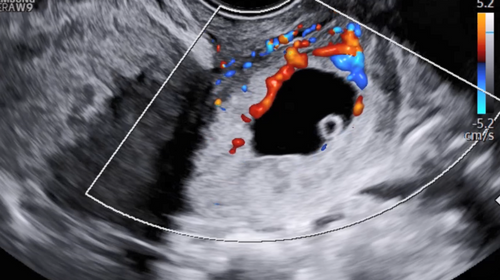 Cervical Ectopic Pregnancy