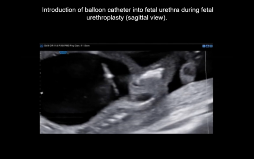 UOG video clip: Urethroplasty with balloon catheterization in fetal ...