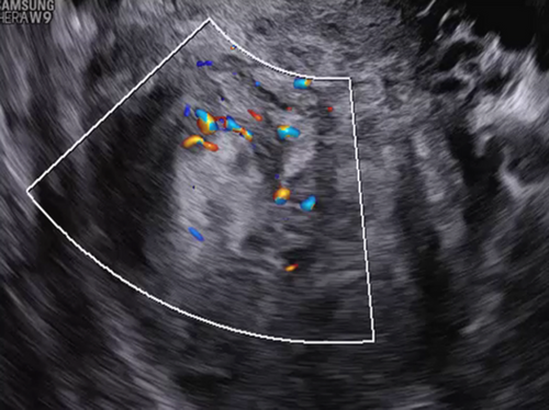 Intramural Ectopic Pregnancy