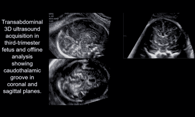 UOG videoclip: Visualization of caudothalamic groove at expert fetal ...