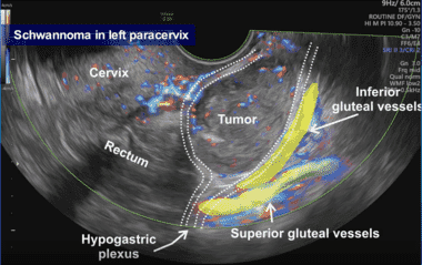 UOG videoclip: Imaging in gynecological disease (26): clinical and ...