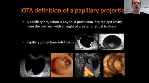 The IOTA approach to classifying ovarian tumours and diagnosing ovarian ...
