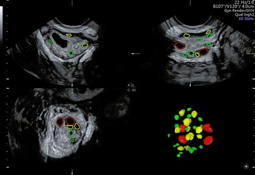 Ultrasound in the investigation of female infertility