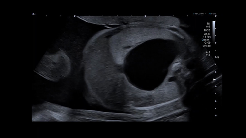 UOG videoclip: Prenatal diagnosis and therapeutic management of giant ...