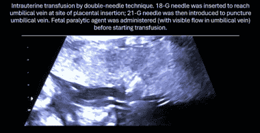 UOG Videoclip: Double-needle intrauterine transfusion technique for ...