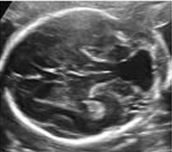 Dandy-Walker Complex