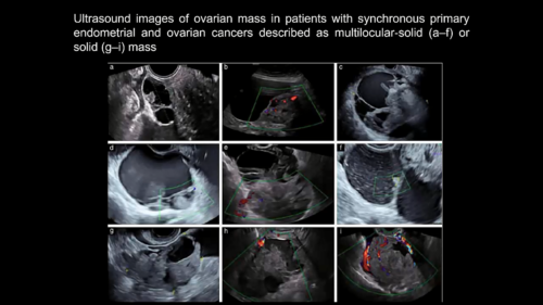 UOG video clip: synchronous primary cancers of endometrium and ovary vs ...