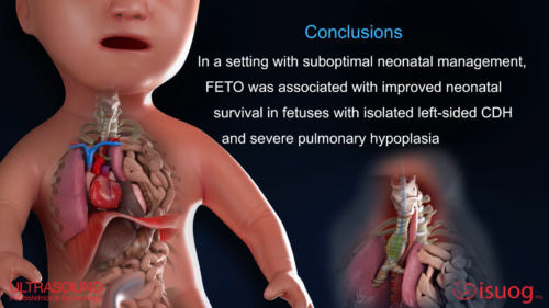 UOG video abstract: Survival outcome in severe left-sided congenital ...