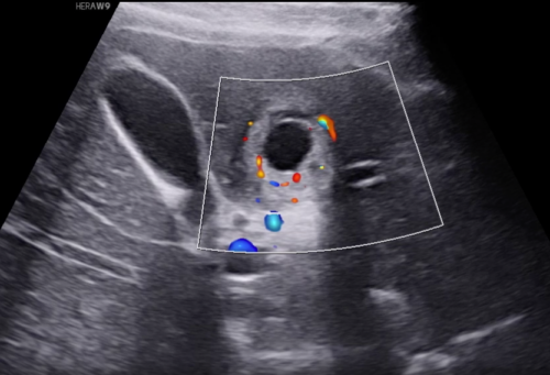 Early Pregnancy Complications: Ectopic Pregnancy