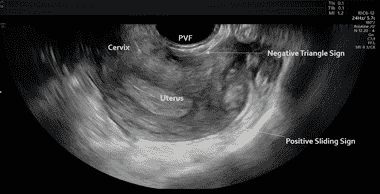 UOG videoclip: 'Triangle sign': novel and needed supplement to sliding ...