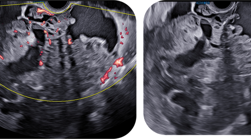 Ovarian masses: imaging and management
