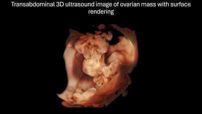 UOG Videoclip: Mixed germ cell tumor presenting with mixed sonographic ...