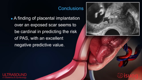 UOG video abstract: Lower uterine segment scar assessment at 11–14 ...