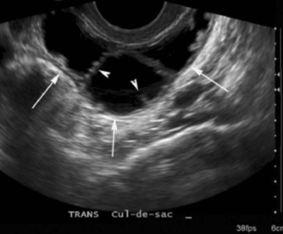 Free Access in February: Explore VISUOG Chapters on Salpingitis and ...