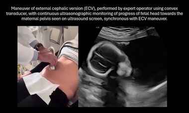 UOG Videoclip: Fetal neurosonography: technique and feasibility of ...