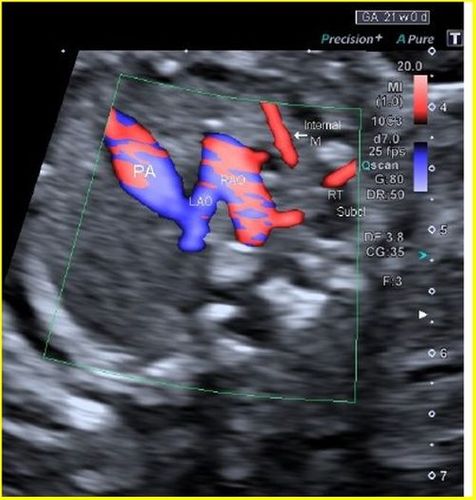 Double Aortic Arch