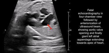 UOG videoclip: Giant left atrial appendage: fetal detection and ...