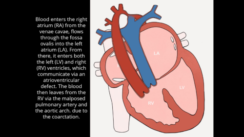 UOG videoclip: Prenatal diagnosis of double-outlet left atrium