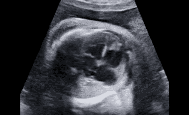 UOG videoclip: Prenatal sonographic phenotype of Raine syndrome ...