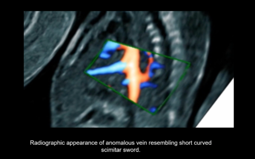 UOG videoclip: Early prenatal diagnosis of scimitar syndrome