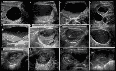 UOG videoclip: Using IOTA terminology to evaluate fetal ovarian cysts ...