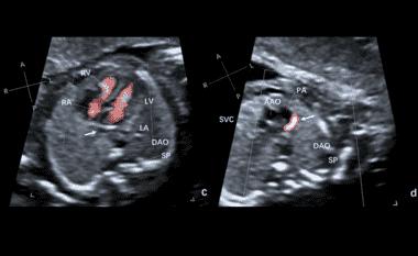 UOG videoclip: Sonographic ‘barber-pole’ sign in fetal jejunoileal ...