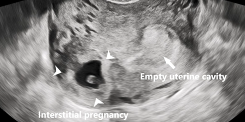 Interstitial Ectopic Pregnancy