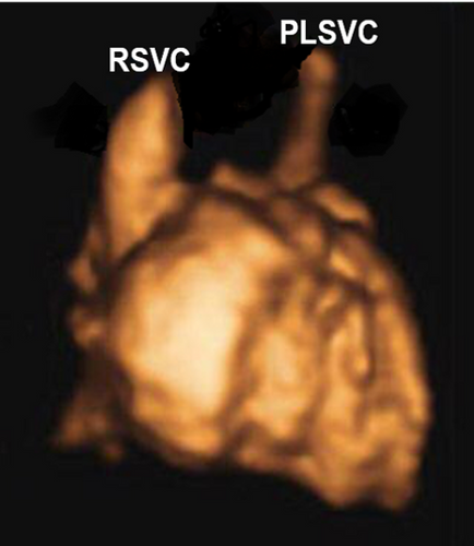 Persistent Left Superior Vena Cava (PLSVC)