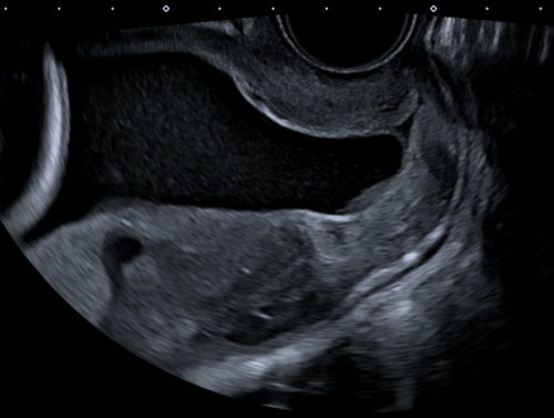 Preterm birth: prediction and prevention through ultrasound