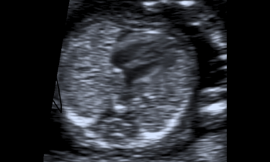 VISUOG's chapter on the First Trimester Fetal Heart is open access this May