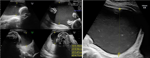 Third Trimester through Ultrasound