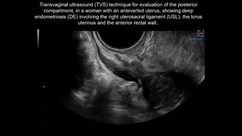 Uterosacral Ligament Endometriosis