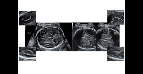 UOG videoclip: Examination of fetal Sylvian fissure can and should be ...
