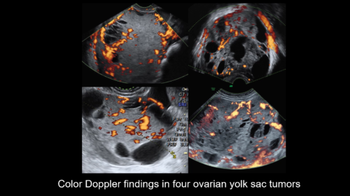 Uog Video Clip Imaging In Gynecological Disease 17 Ultrasound