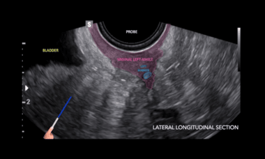 UOG Videoclip: How to check correct position of fiducial markers on ...