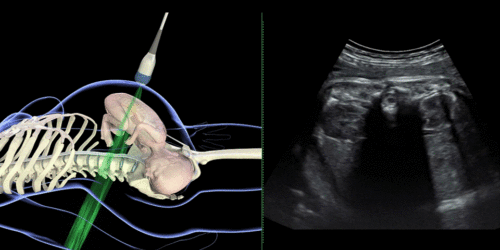 How to perform fetal ultrasound in labor: assessment of fetal occiput ...