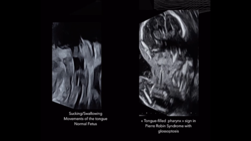 UOG videoclip: Tongue-filled pharynx sign: new simple ultrasound clue ...