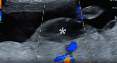 UOG videoclip: Placental lakes vs lacunae: spot the differences