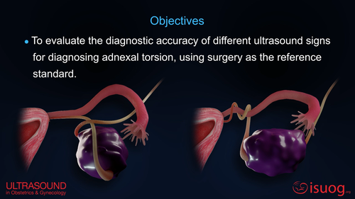 UOG video abstract: Diagnostic accuracy of ultrasound signs for ...
