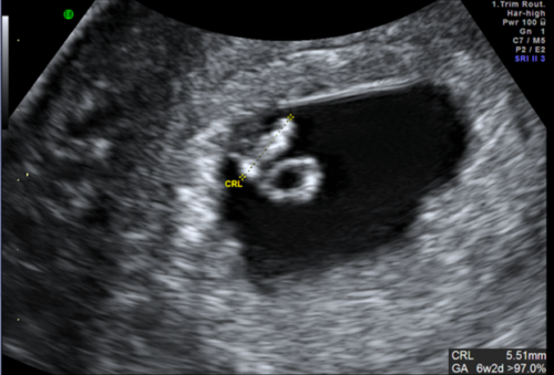 Expert Voice: Baby Loss and Miscarriage