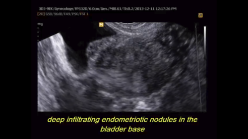 Sonographic evaluation of the pelvis in women with suspected endometriosis