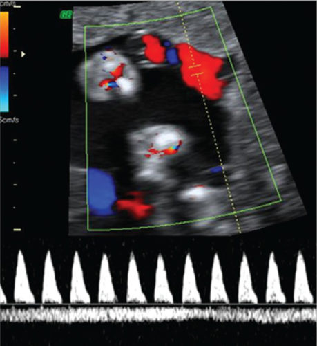 Doppler and maternal vascular imaging