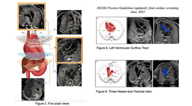 UOG videoclip: Enhancement of screening examination of fetal heart as ...