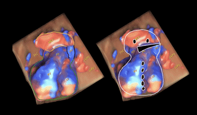 UOG videoclip: Fetal snowman sign: four-dimensional imaging of ...