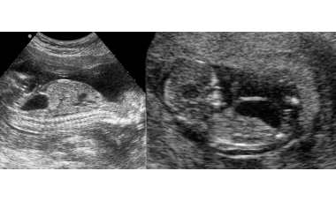 Fetal megacystis: a lot more than LUTO, finds new UOG article